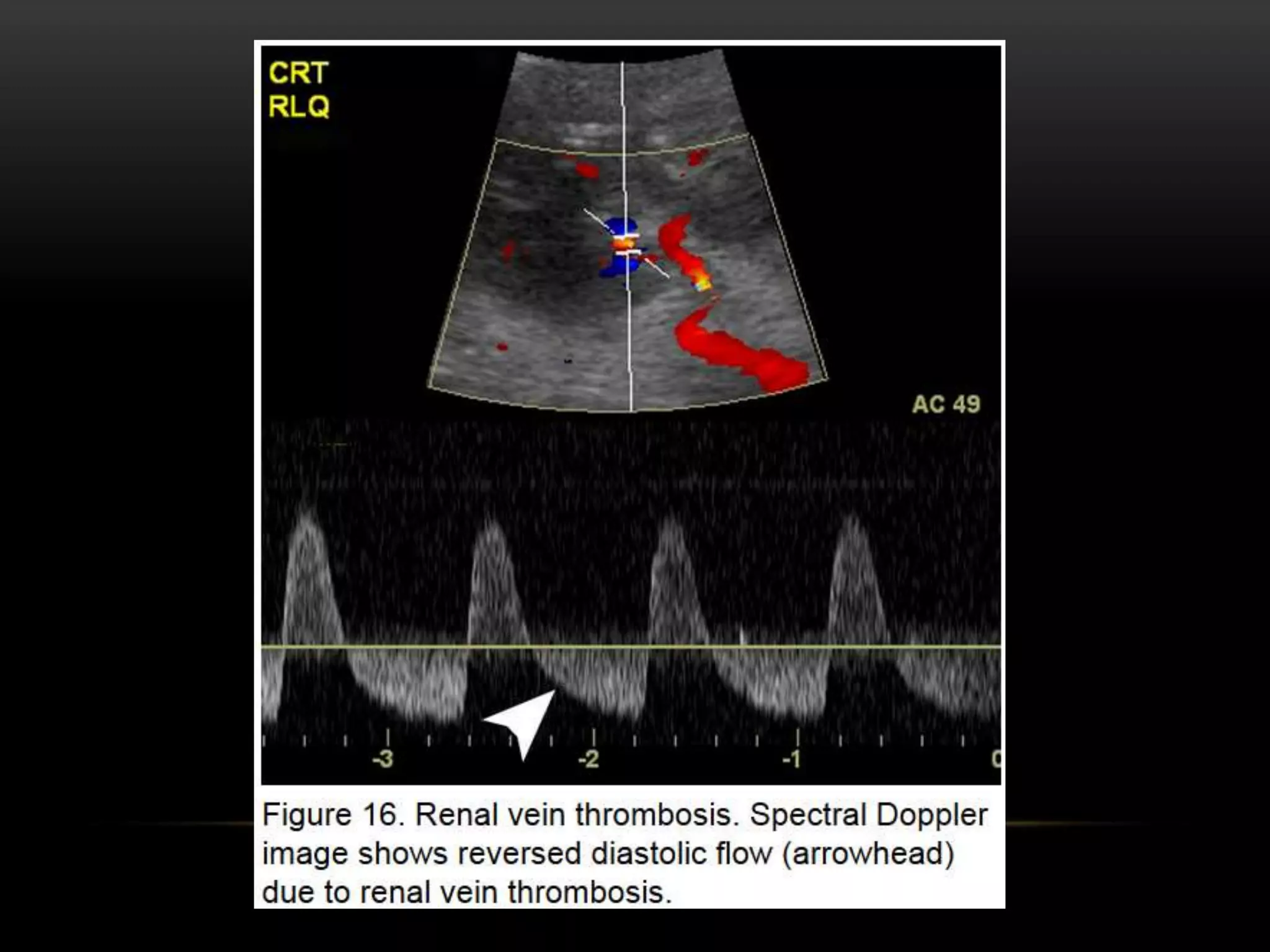Renal doppler usg | PPTX
