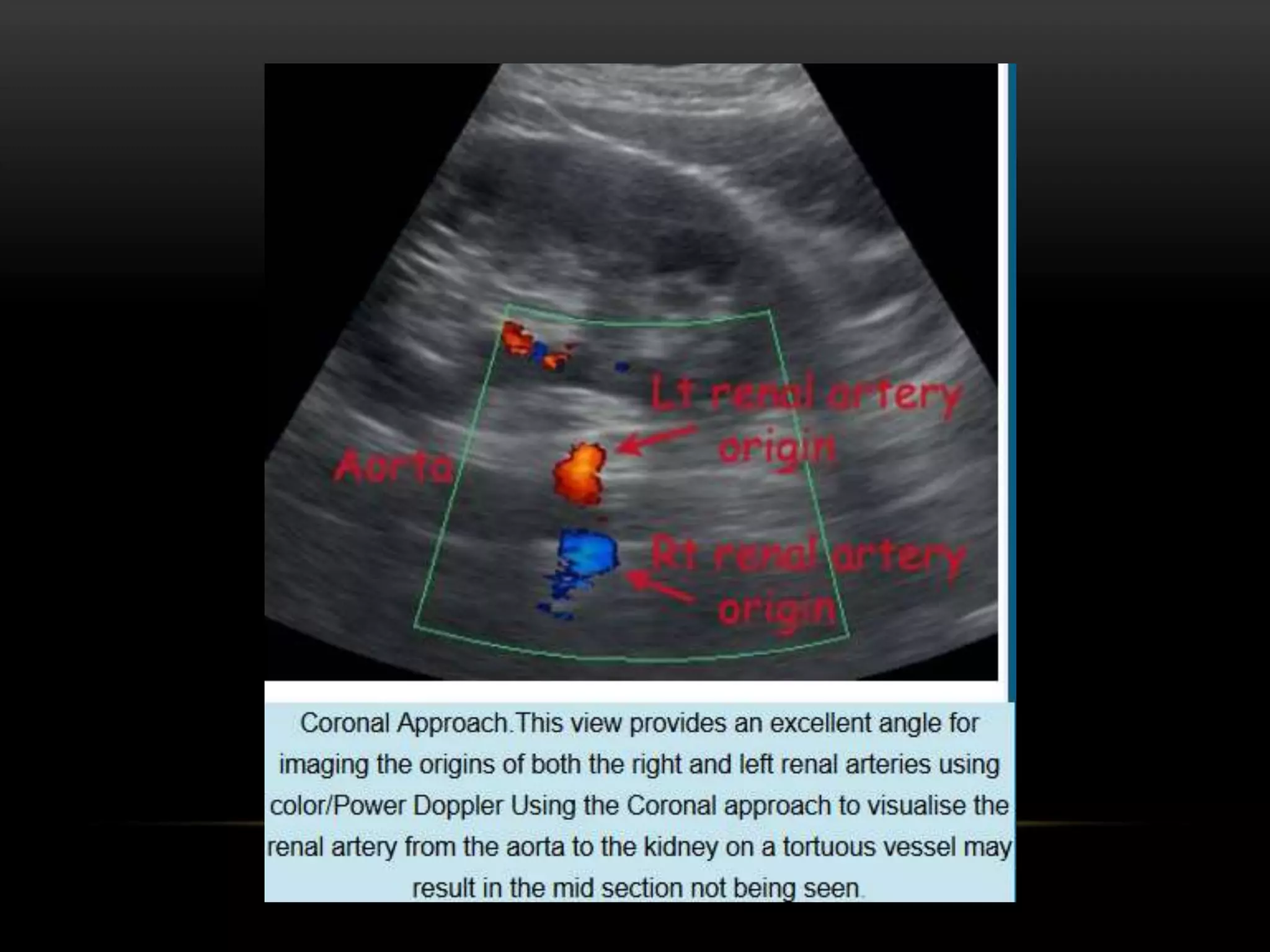 Renal doppler usg | PPTX