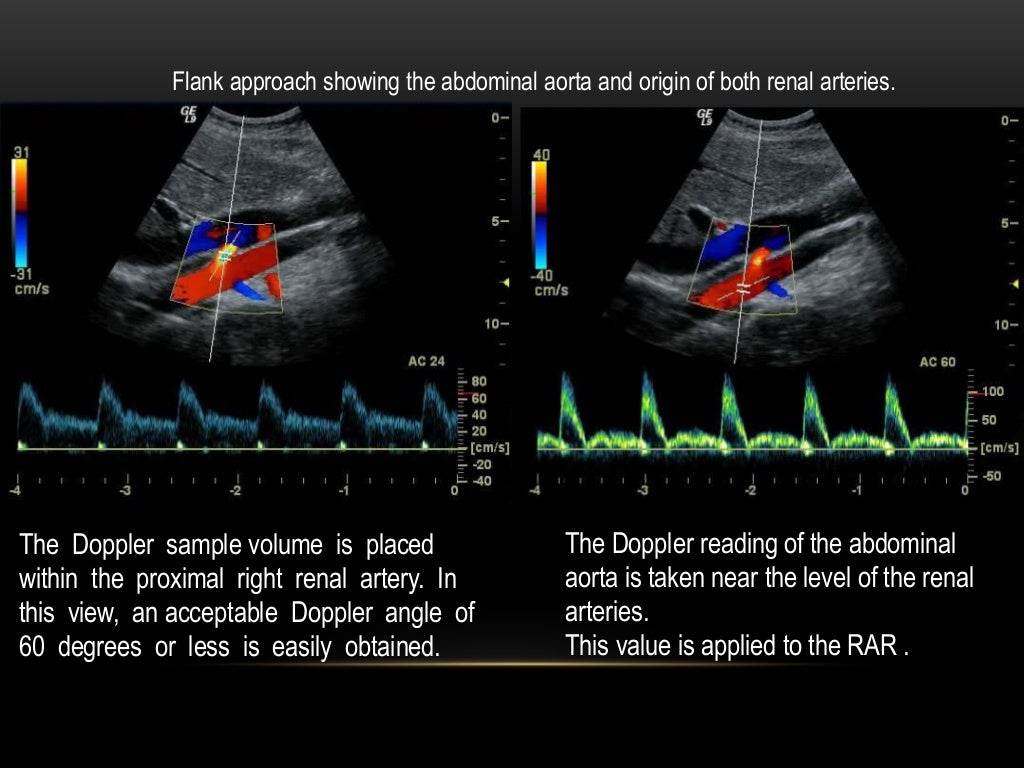 Renal doppler usg