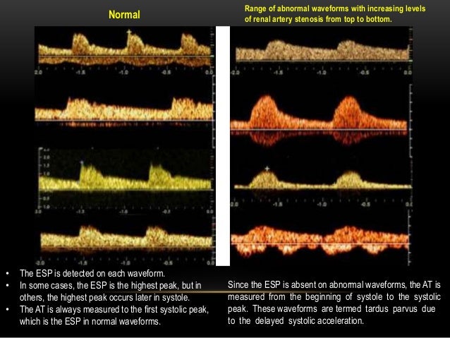 Renal doppler usg