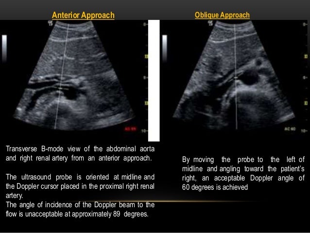 Renal doppler usg