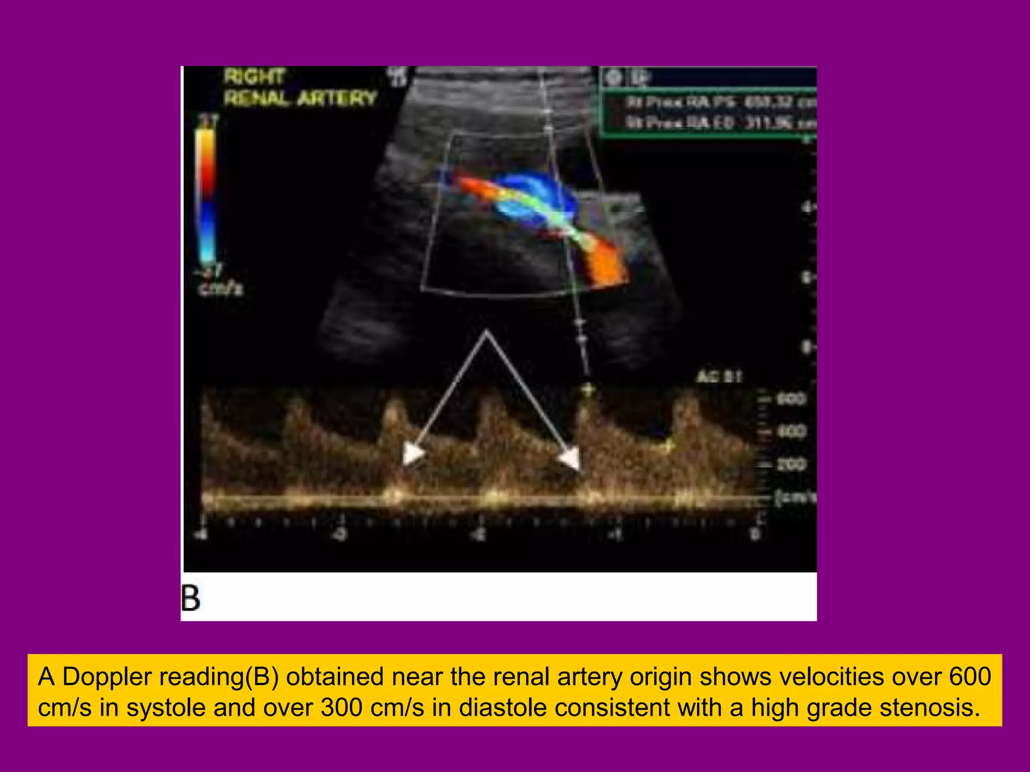 Renal doppler ultrasound | PPT