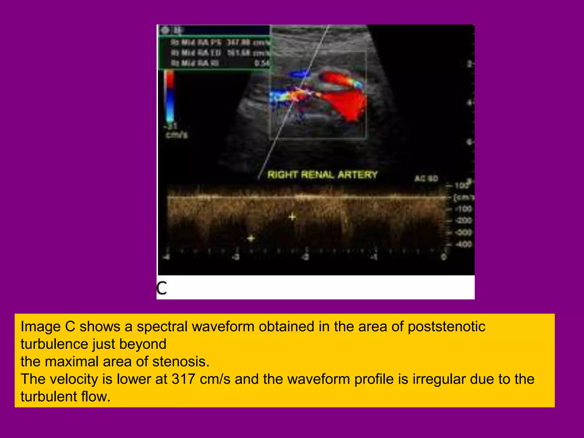Renal doppler ultrasound | PPT