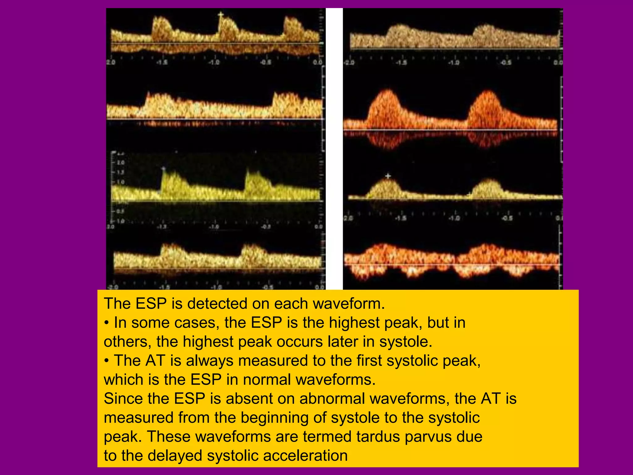 Renal doppler ultrasound | PPT