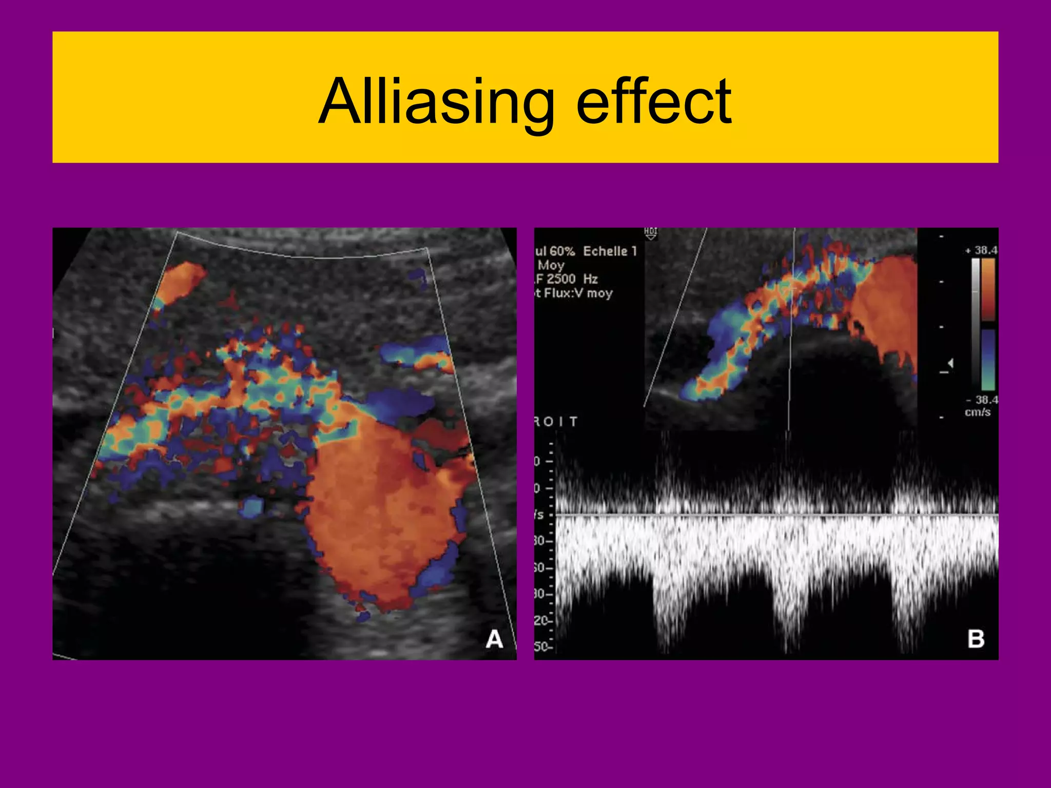 Renal doppler ultrasound | PPT