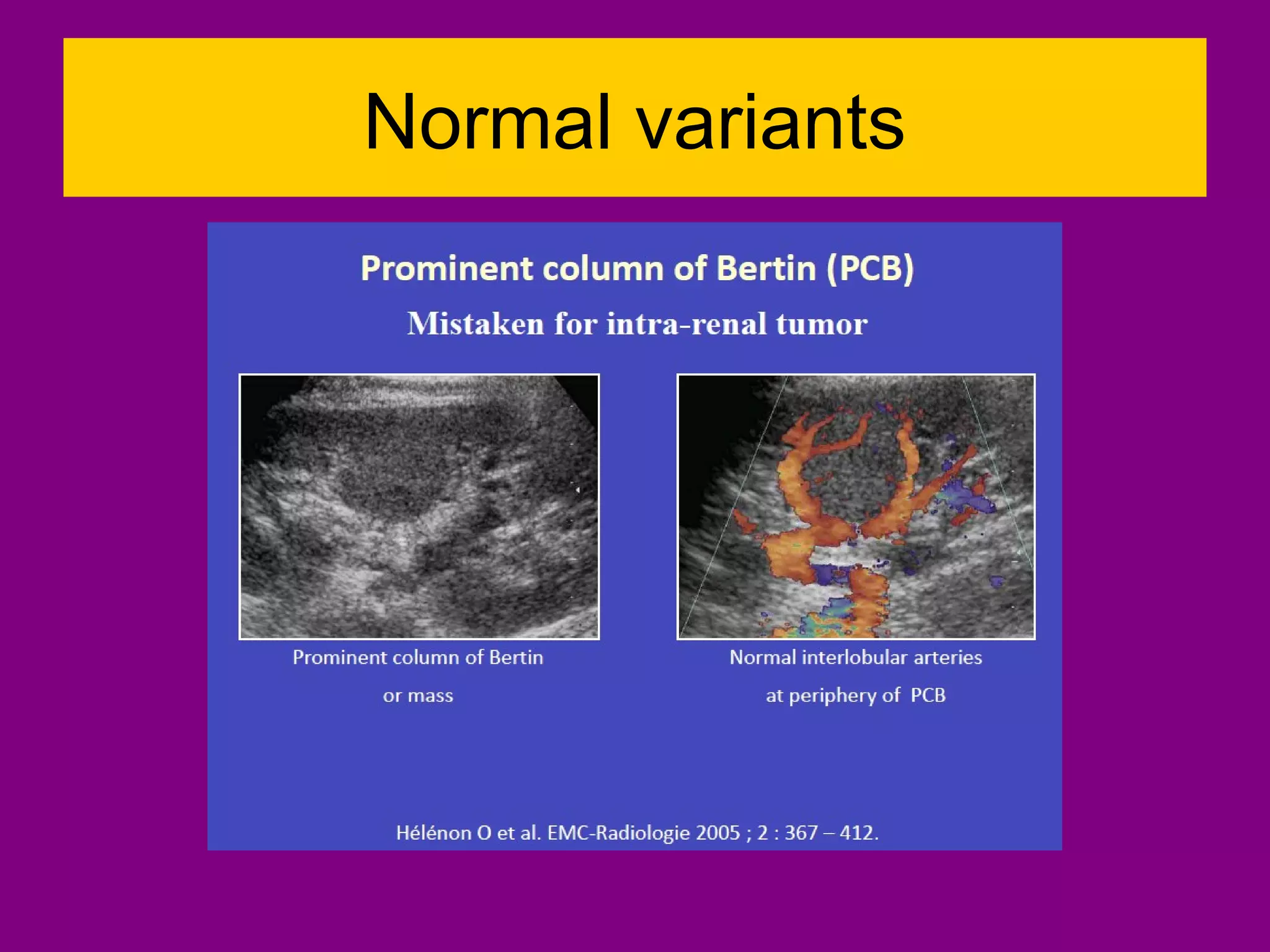 Renal doppler ultrasound | PPT