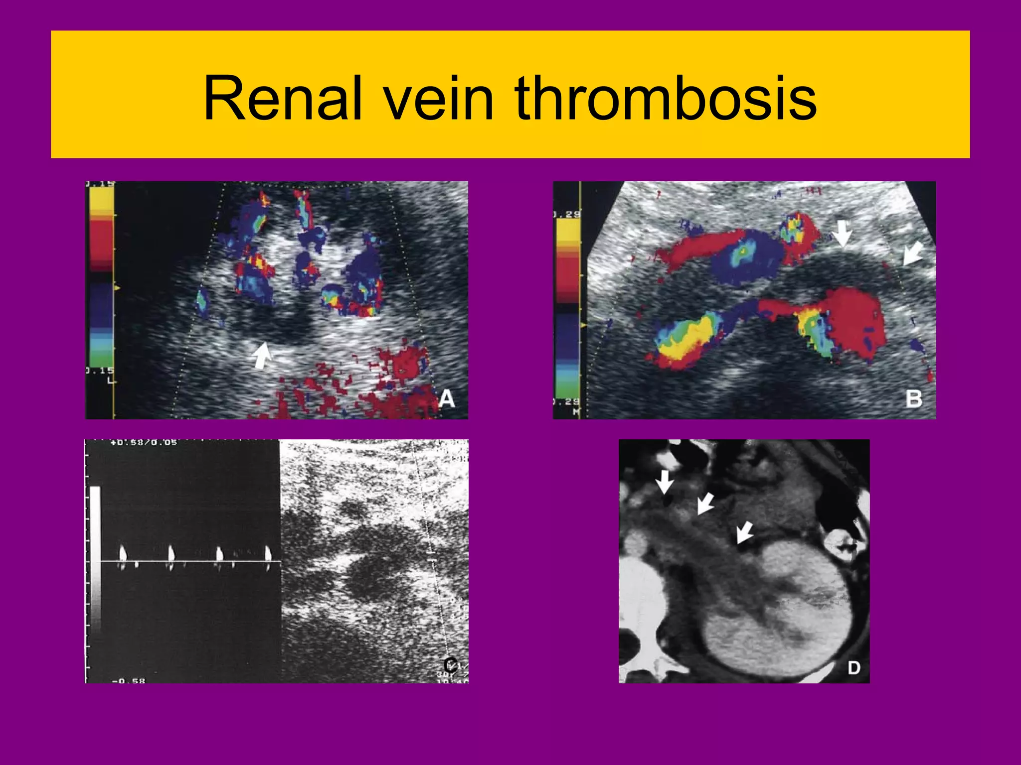 Renal doppler ultrasound | PPT