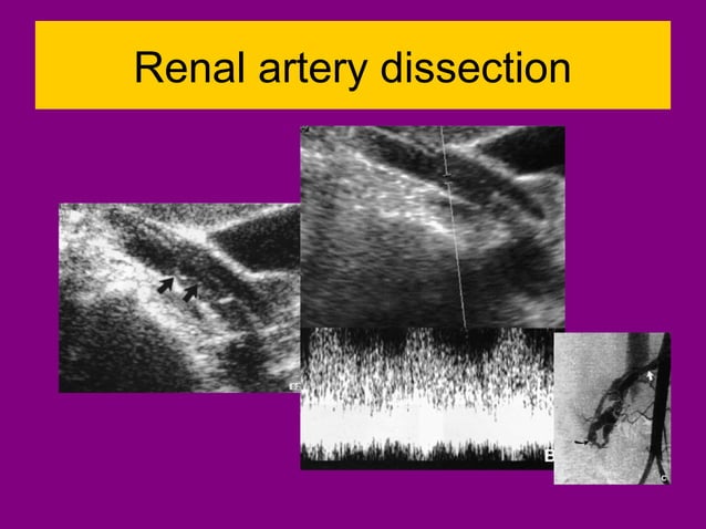 Renal doppler ultrasound | PPT