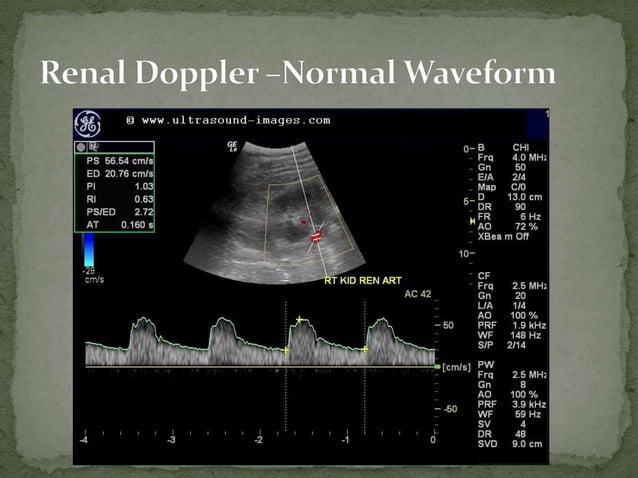 Renal doppler | PPTX | Medical Tests | Medical Health