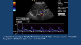 Basics of Renal Doppler | PPTX
