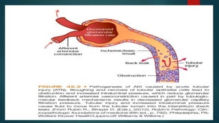 RENAL FAILURE | PPTX