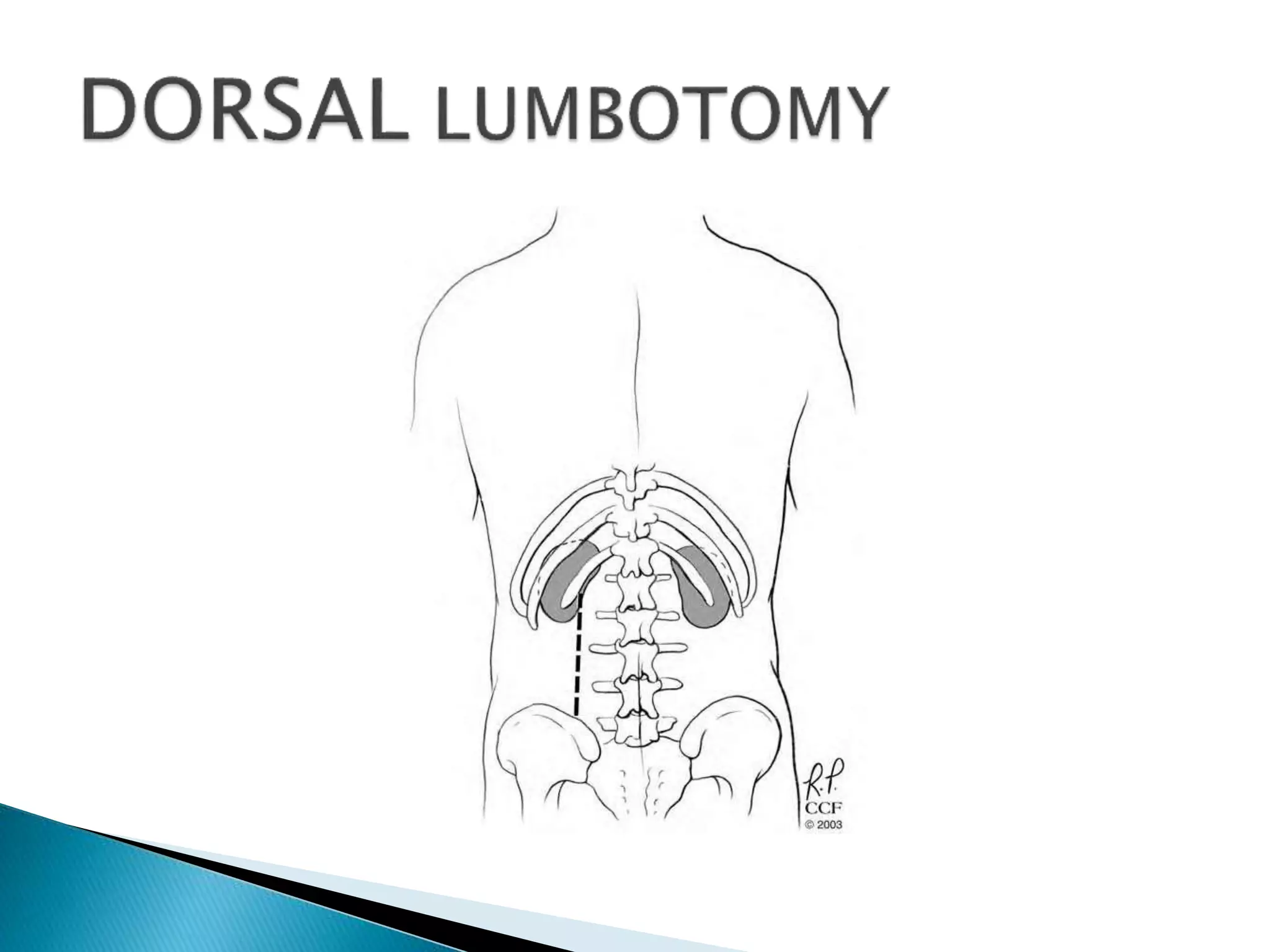 Renal incision | PPTX