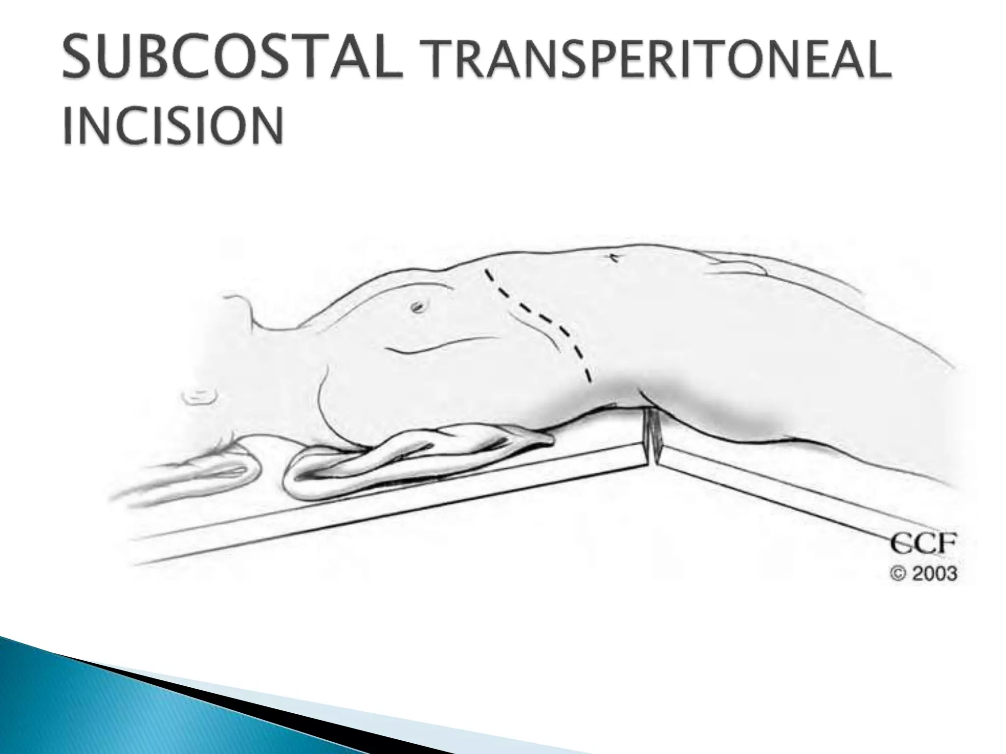 Renal incision | PPTX | Death, Injury, or Military Conflict | Sensitive ...