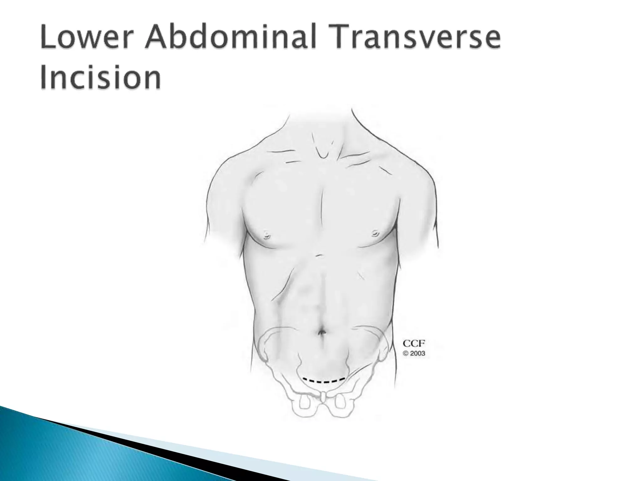 Renal incision | PPTX