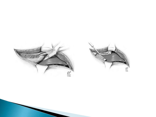 Renal incision | PPTX | Death, Injury, or Military Conflict | Sensitive ...