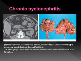 Renal infections radiology | PPTX