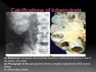 Renal infections radiology | PPTX