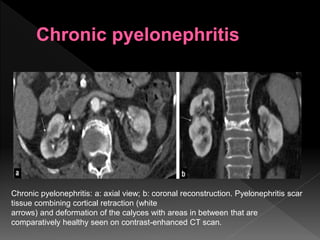 Chronic Pyelonephritis Ultrasound