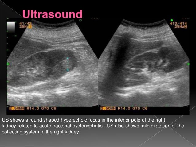 Renal infections radiology