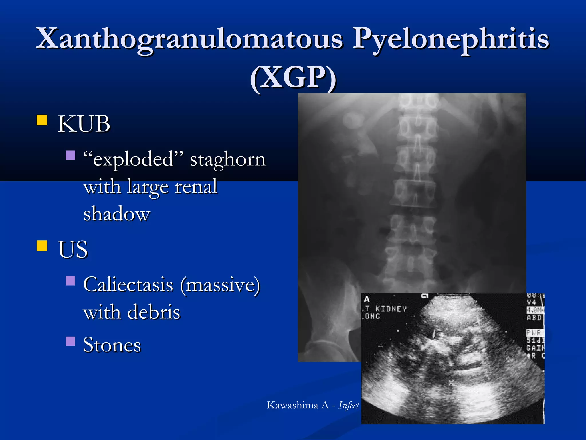 Renal inflammatory disease | PPT