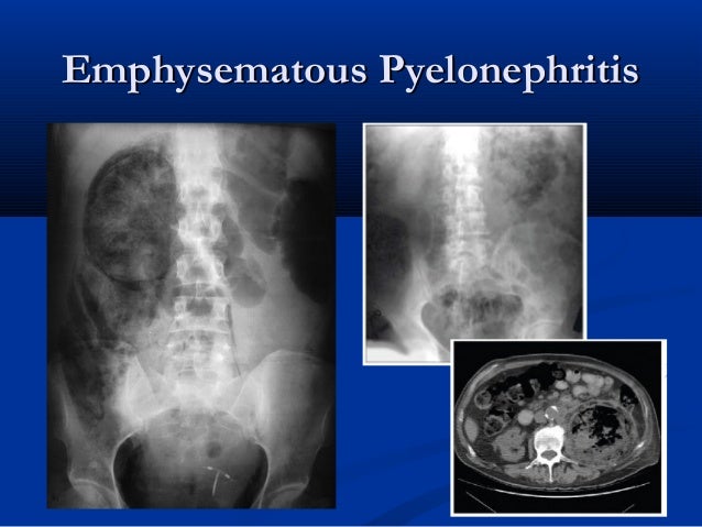 Renal inflammatory disease