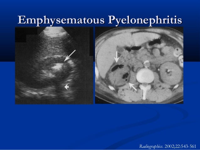 Renal inflammatory disease