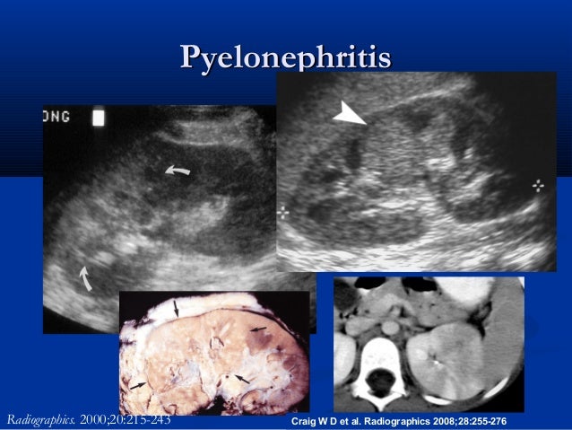 Renal inflammatory disease