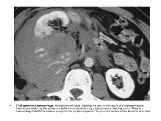 Renal injury-RADIOLOGY | PPTX