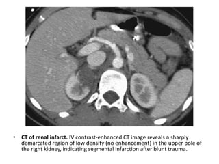 Renal injury-RADIOLOGY | PPTX