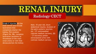 RENAL INJURY-ABDOMINAL TRAUMA.pptx