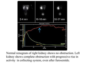 Renal isotope scan | PPTX