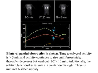 Renal isotope scan | PPTX