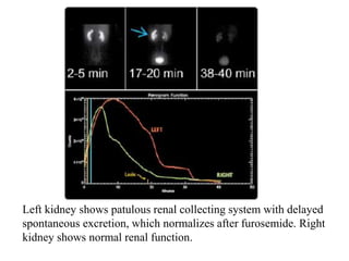 Renal isotope scan | PPTX