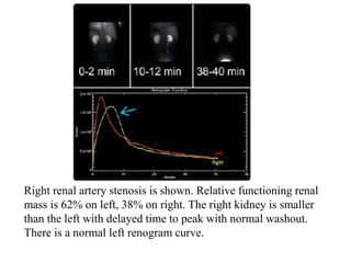 Renal isotope scan | PPTX