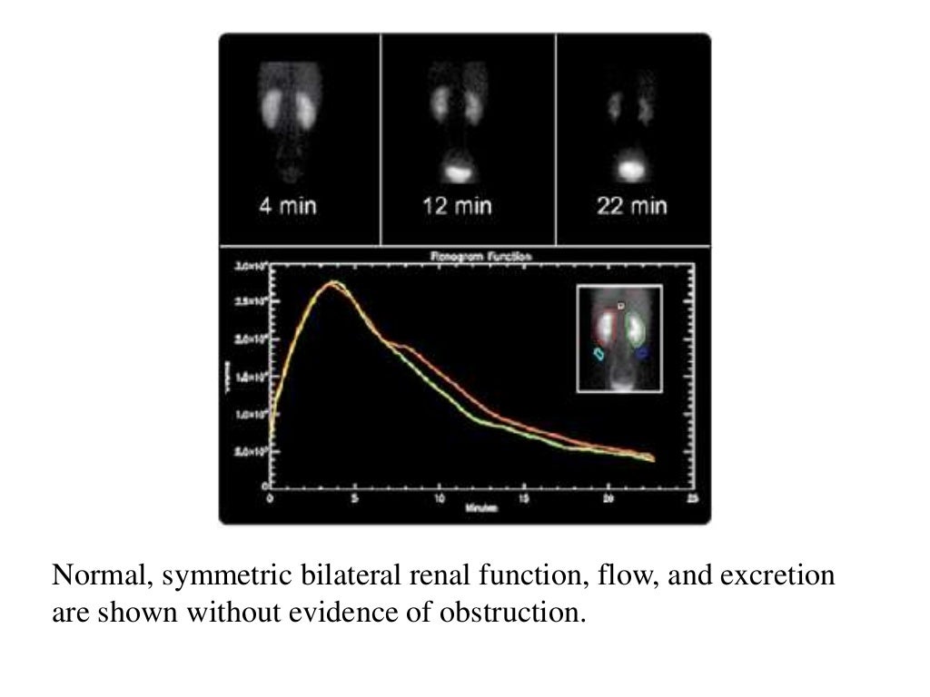 Renal isotope scan