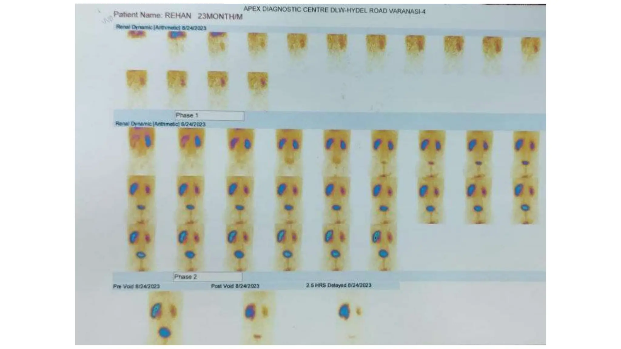 Renal Dynamic Scan - Isotope Scan - DTPA | PPTX
