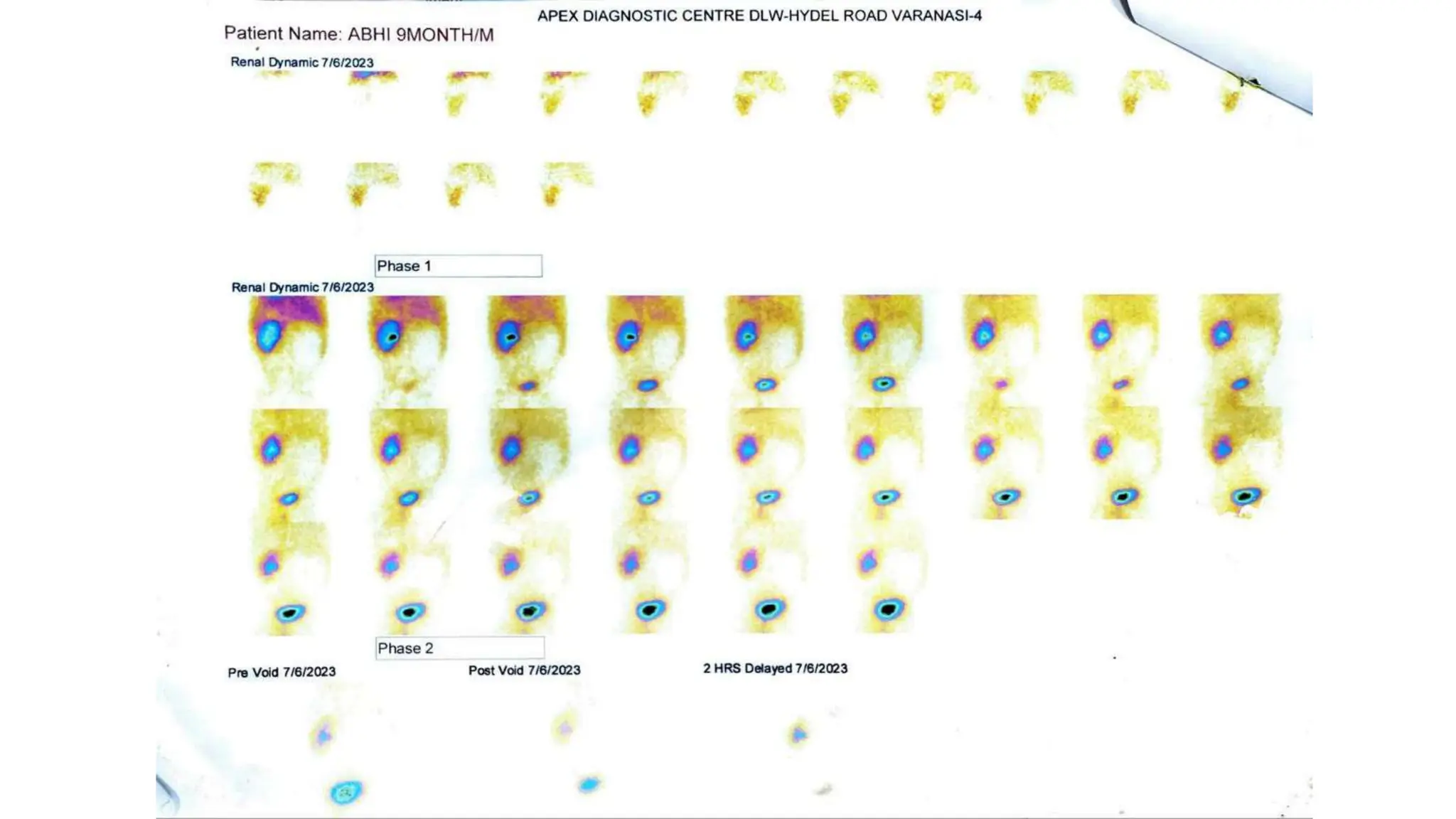 Renal Dynamic Scan - Isotope Scan - DTPA | PPTX