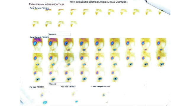 Renal Dynamic Scan - Isotope Scan - DTPA | PPTX