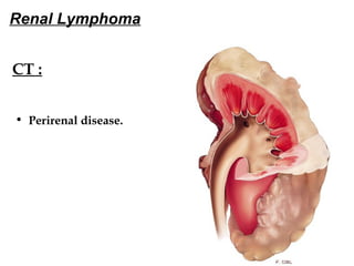 Renal lymphoma | PPT