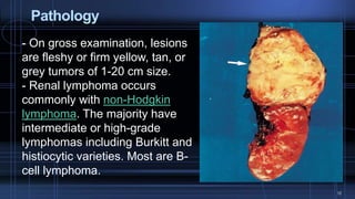 Renal lymphoma | PPTX
