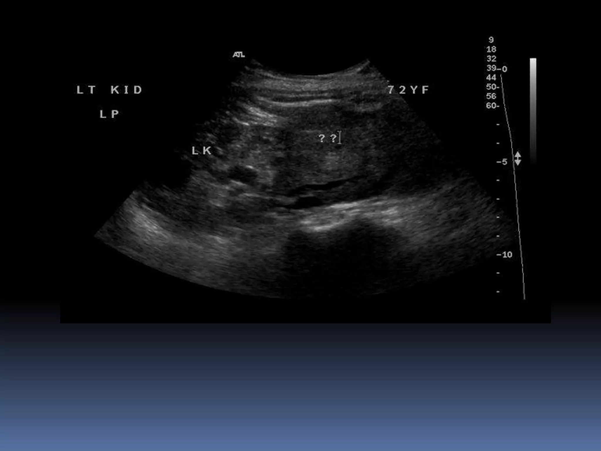 SOLID RENAL MASSES imaging | PPTX