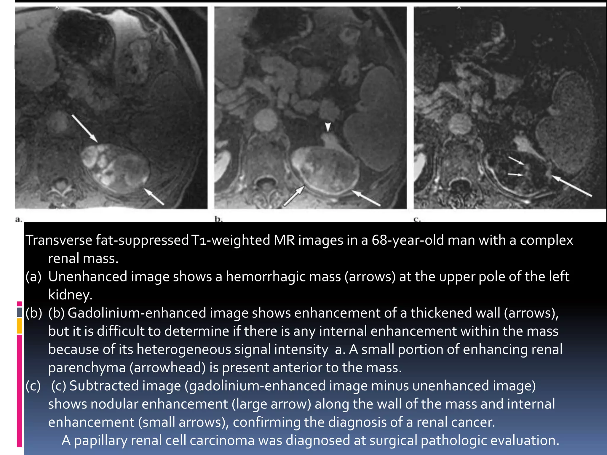 SOLID RENAL MASSES imaging | PPTX