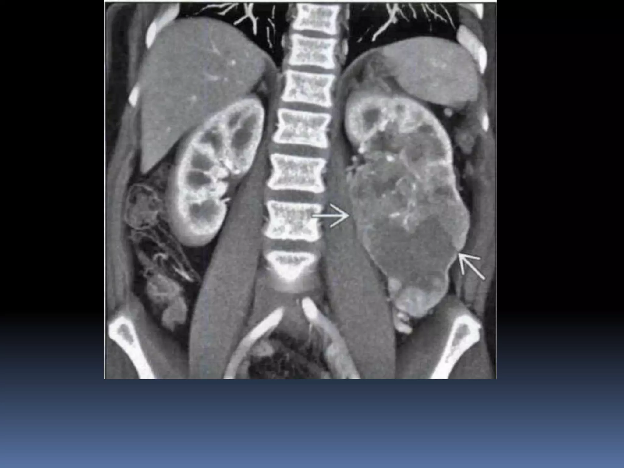 SOLID RENAL MASSES imaging | PPTX