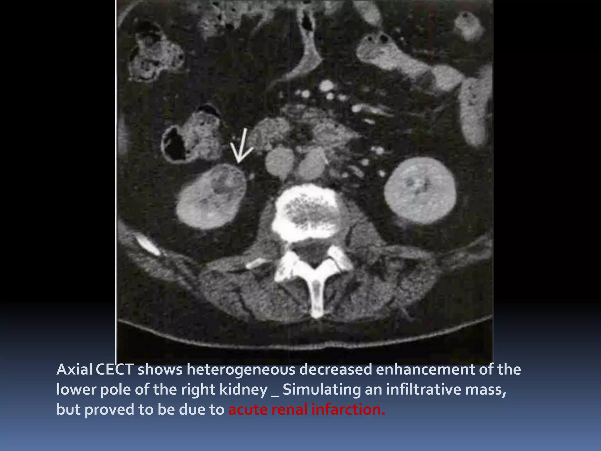SOLID RENAL MASSES imaging | PPTX