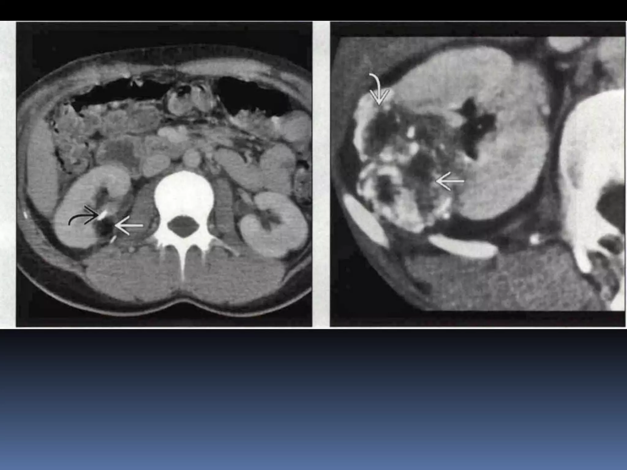 SOLID RENAL MASSES imaging | PPTX