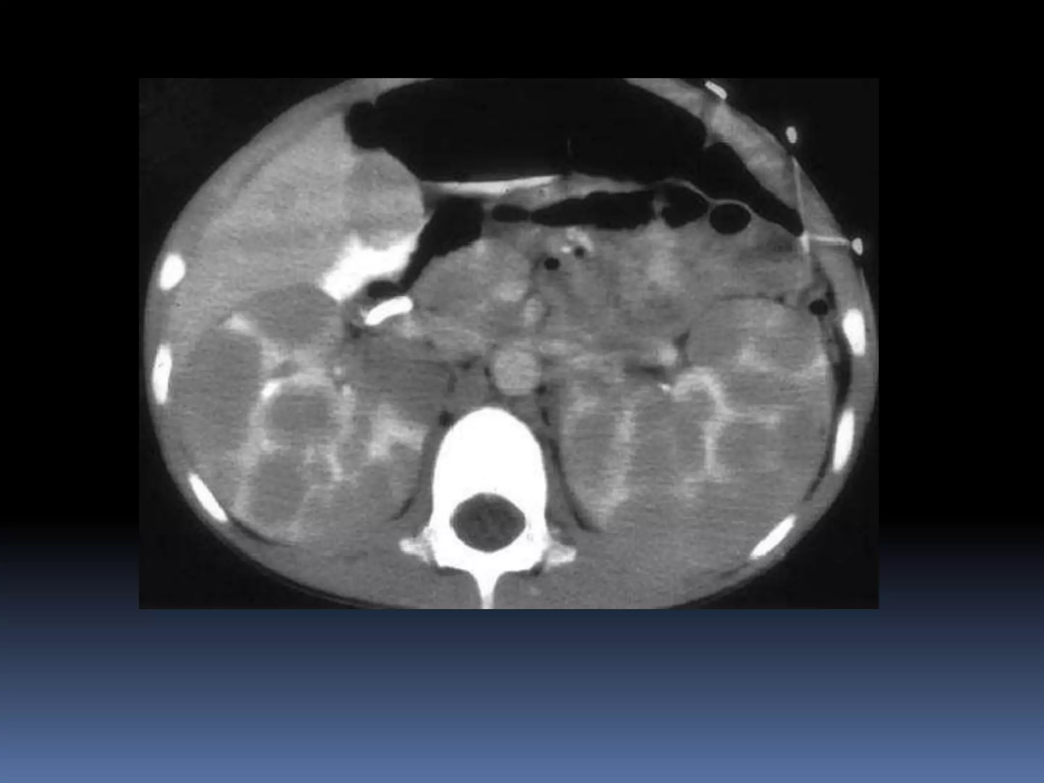 SOLID RENAL MASSES imaging | PPTX