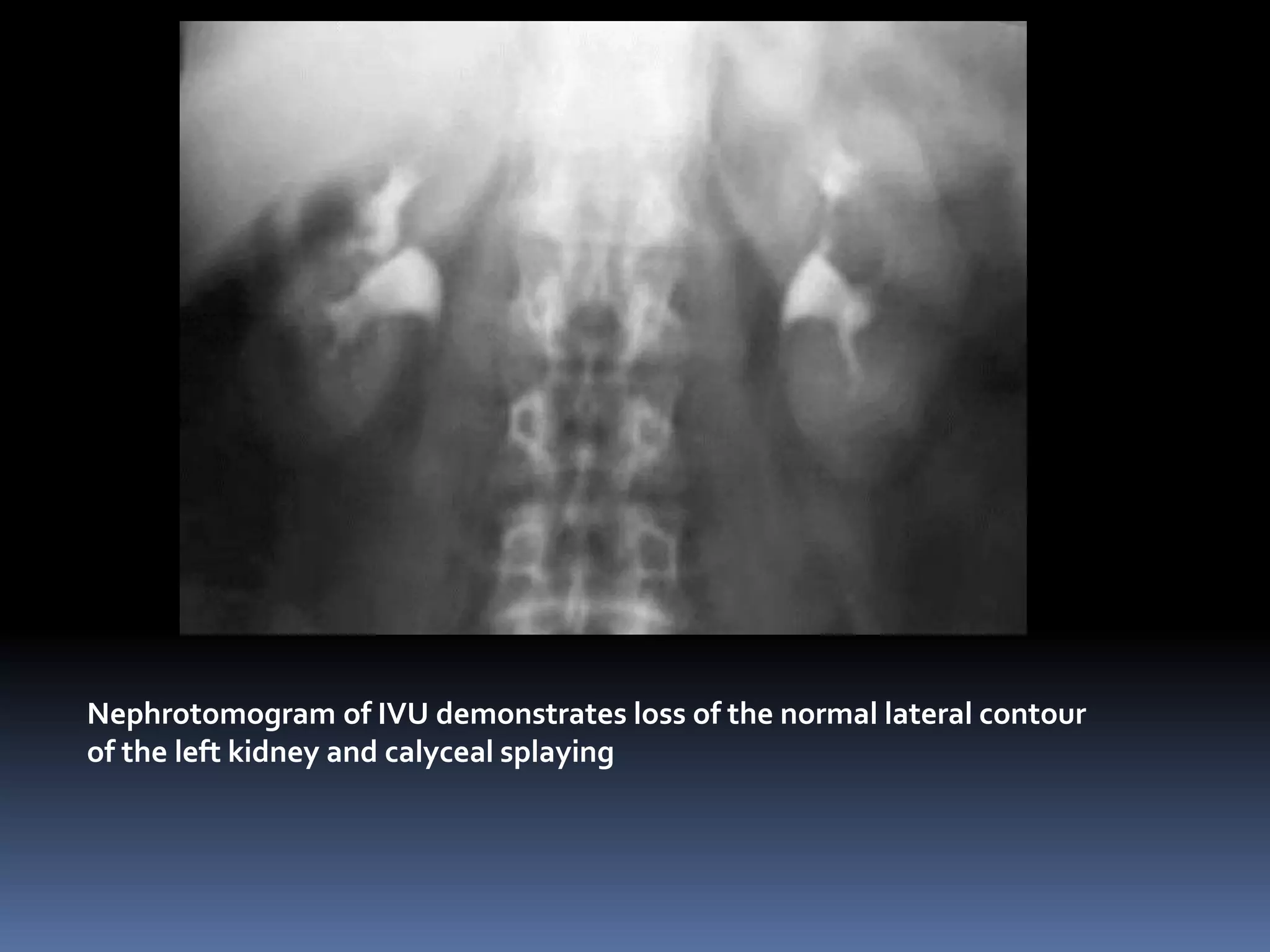 SOLID RENAL MASSES imaging | PPTX