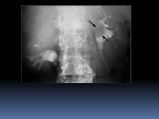 SOLID RENAL MASSES imaging | PPTX