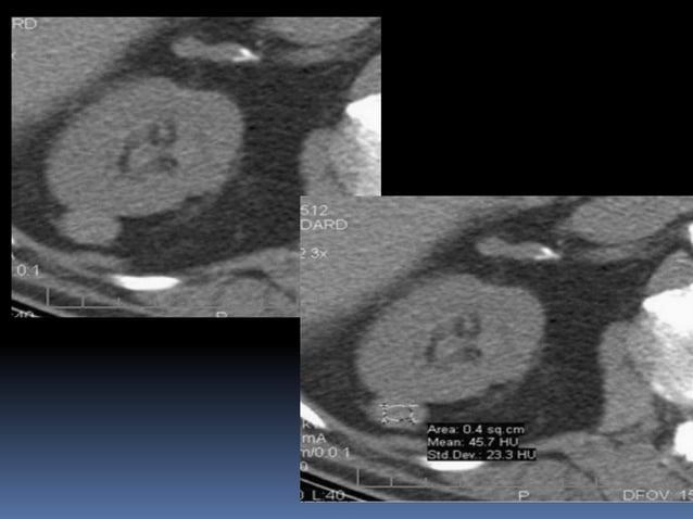 SOLID RENAL MASSES imaging | PPTX
