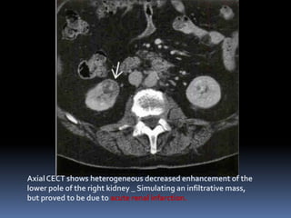 SOLID RENAL MASSES imaging | PPTX